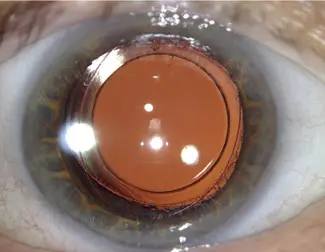 عتامة الكبسولة الخلفية للعين: أسباب إعتام عدسة العين الثانوي